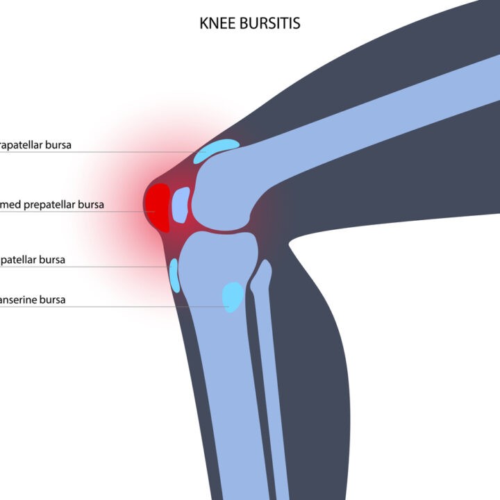 Knee Archives - Ross Center For Orthopedics | Hainesport, NJ